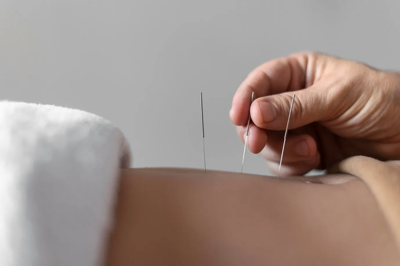 Dry Needling In Midland | Cultivate Wellness & Sports Rehab